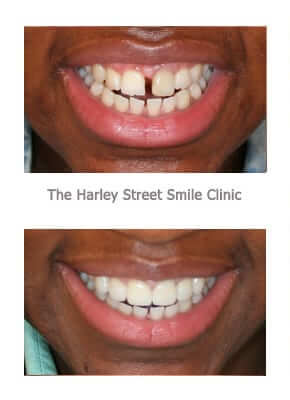 Gummy Smile & Gappy Teeth Smile Gallery - Harley Street Smile Clinic