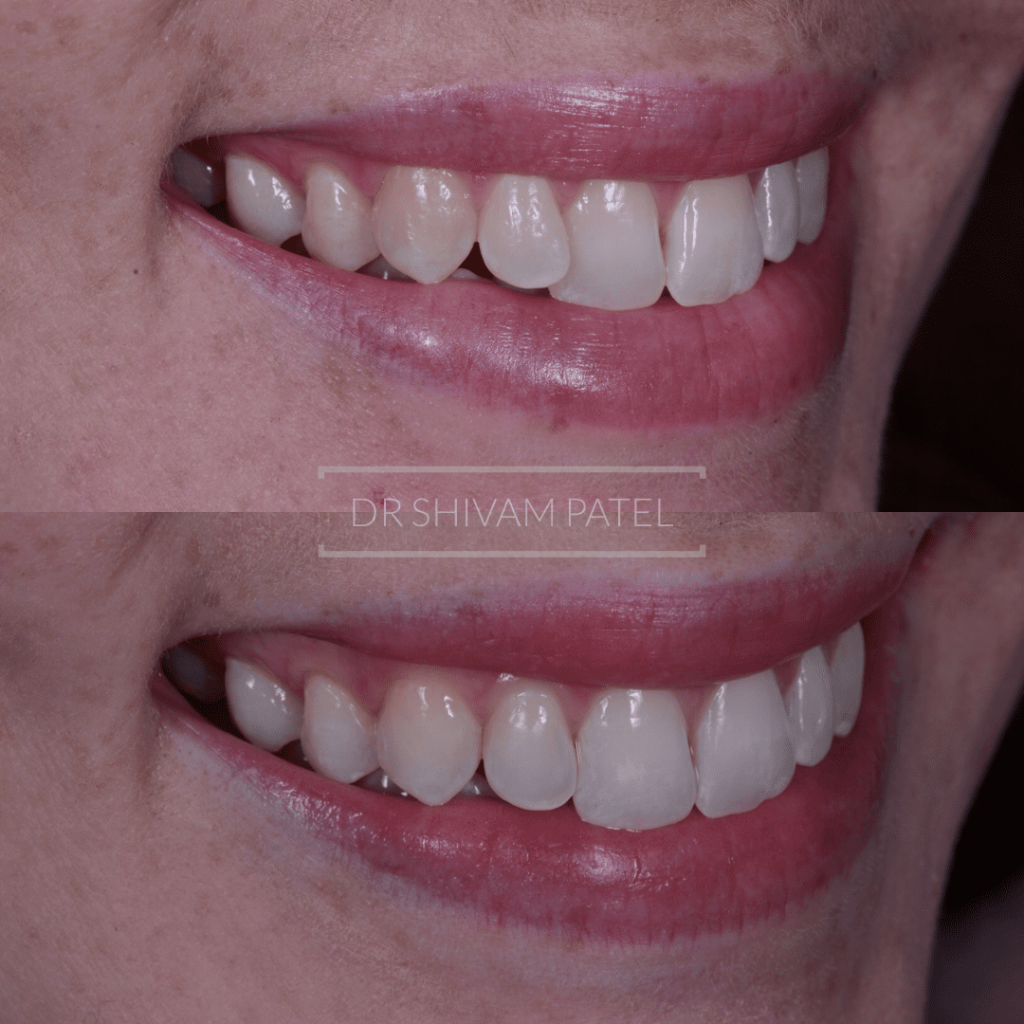 Invisalign - Harley Street Smile Clinic